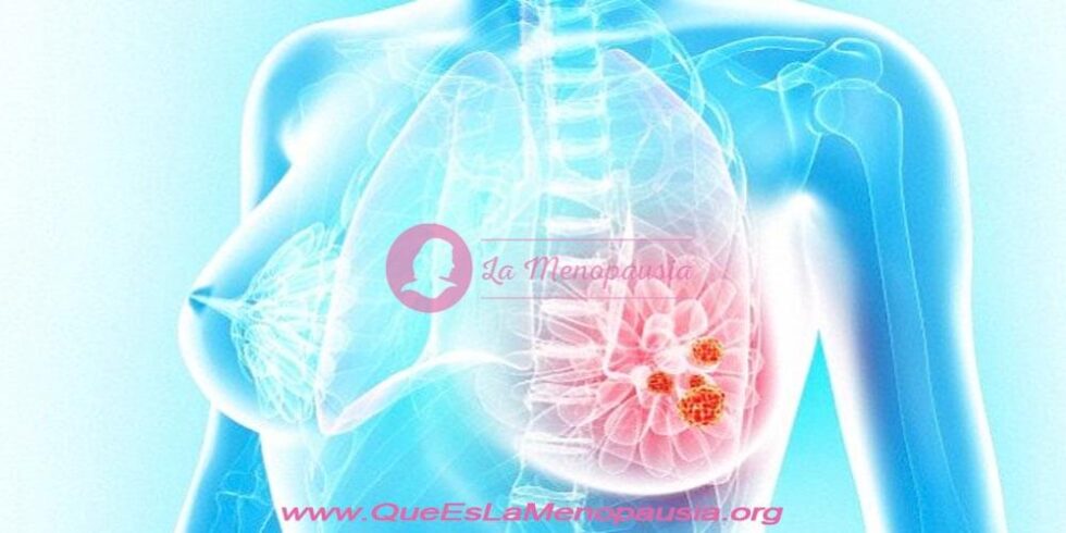 Cáncer de Mama: Guía Completa [ Actualizado 2025 ]